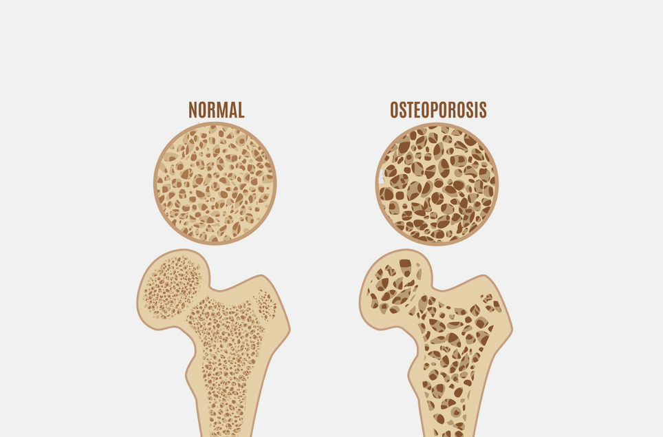 Bone Formation Deficiencies in Glucocorticoid-Induced Osteoporosis