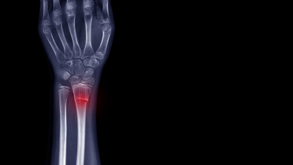 Chinese Study Shows Bone Formation Requires NMN
