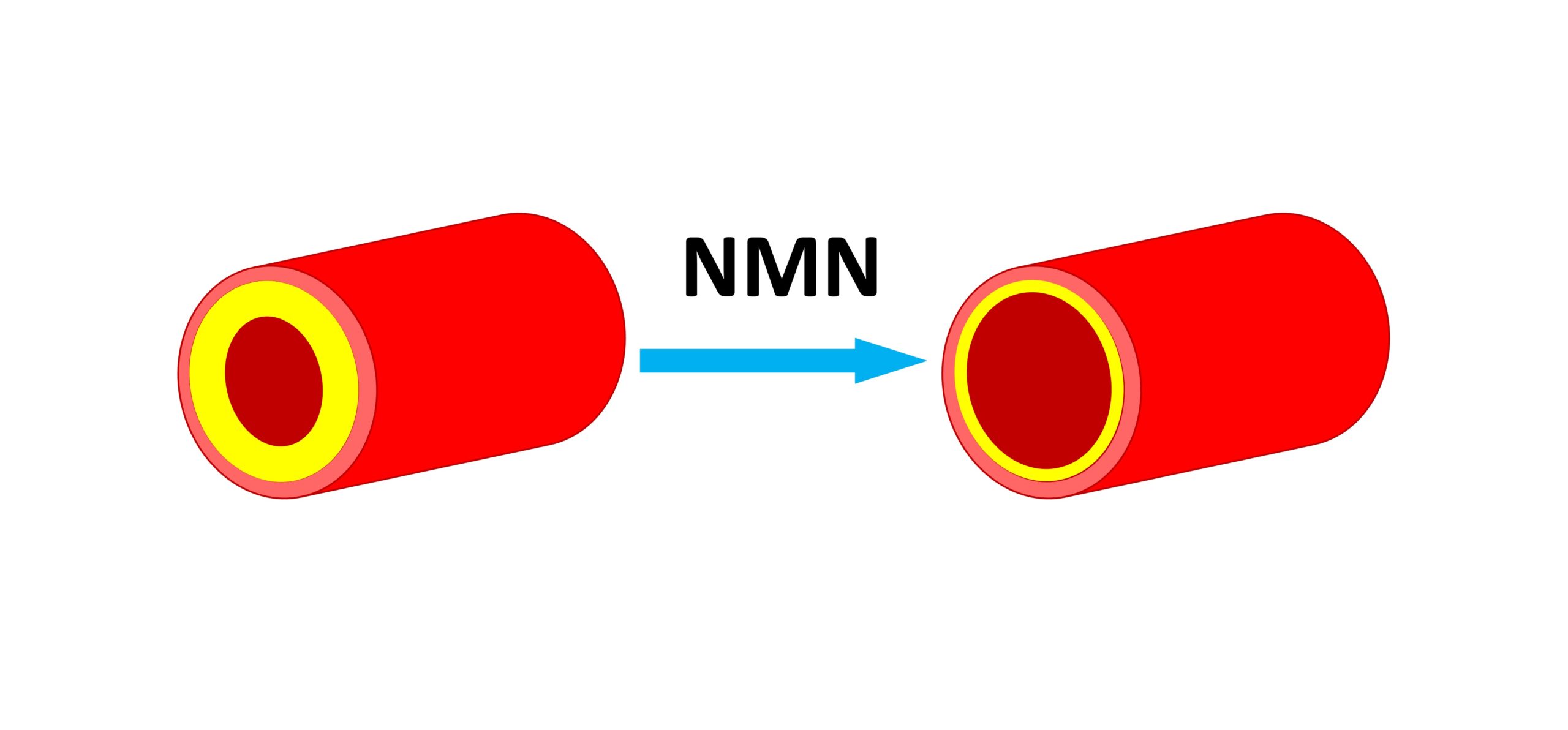 NMN Prevents Clogged Arteries and Protects Against Plaque Bursting, A New Study Shows